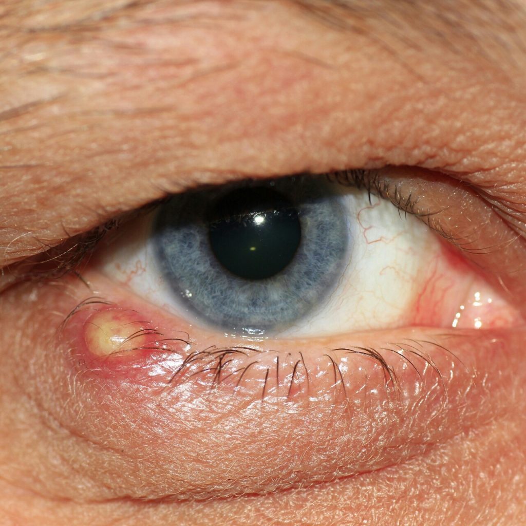 How To Treat A Stye Naturally Medically DrugsBank How To Treat A Stye Naturally Medically DrugsBank