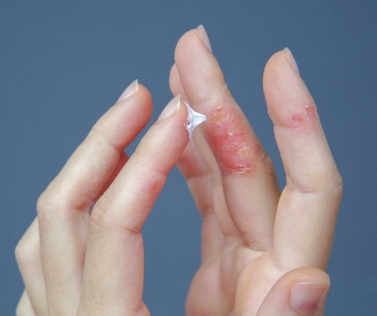 Dyshidrotic Eczema Small Bumps On Hands: Causes, Treatments, Symptoms ...